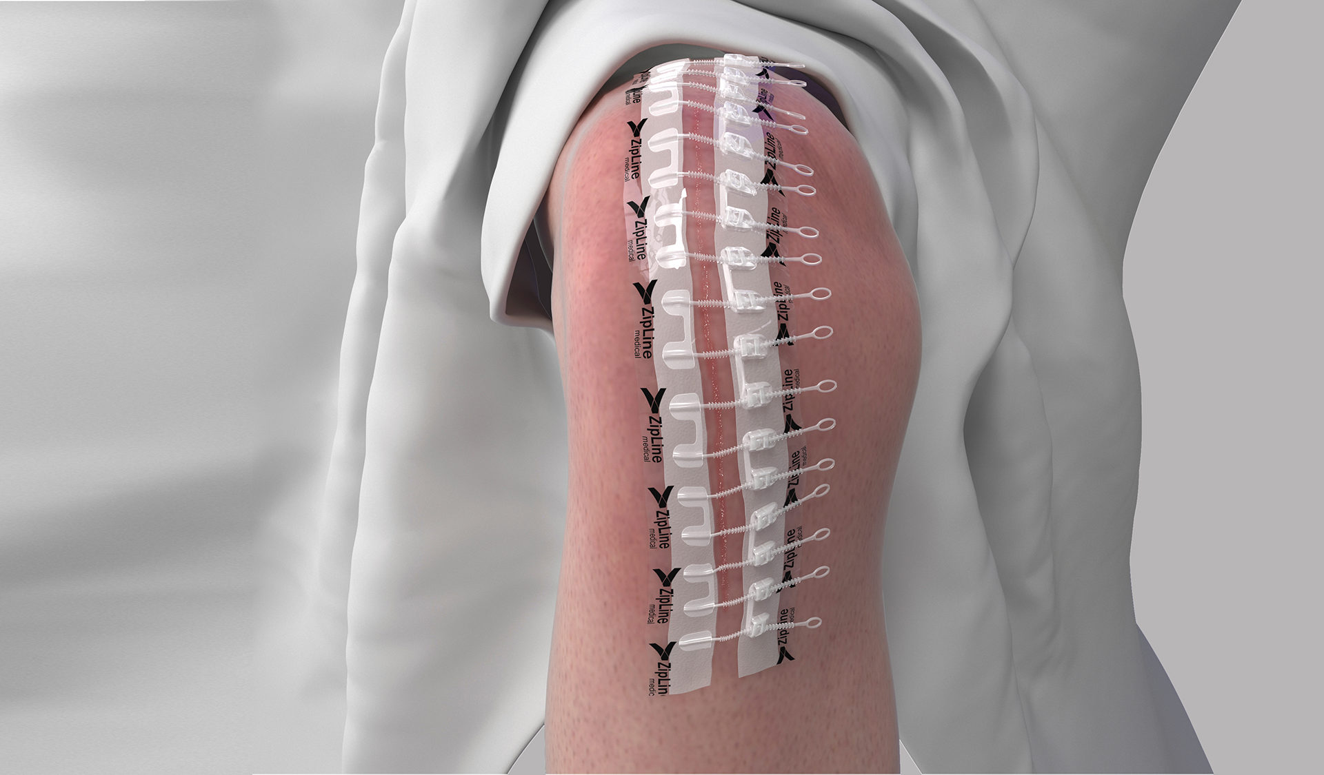 What Is Zip Stryker Zip Skin Closure